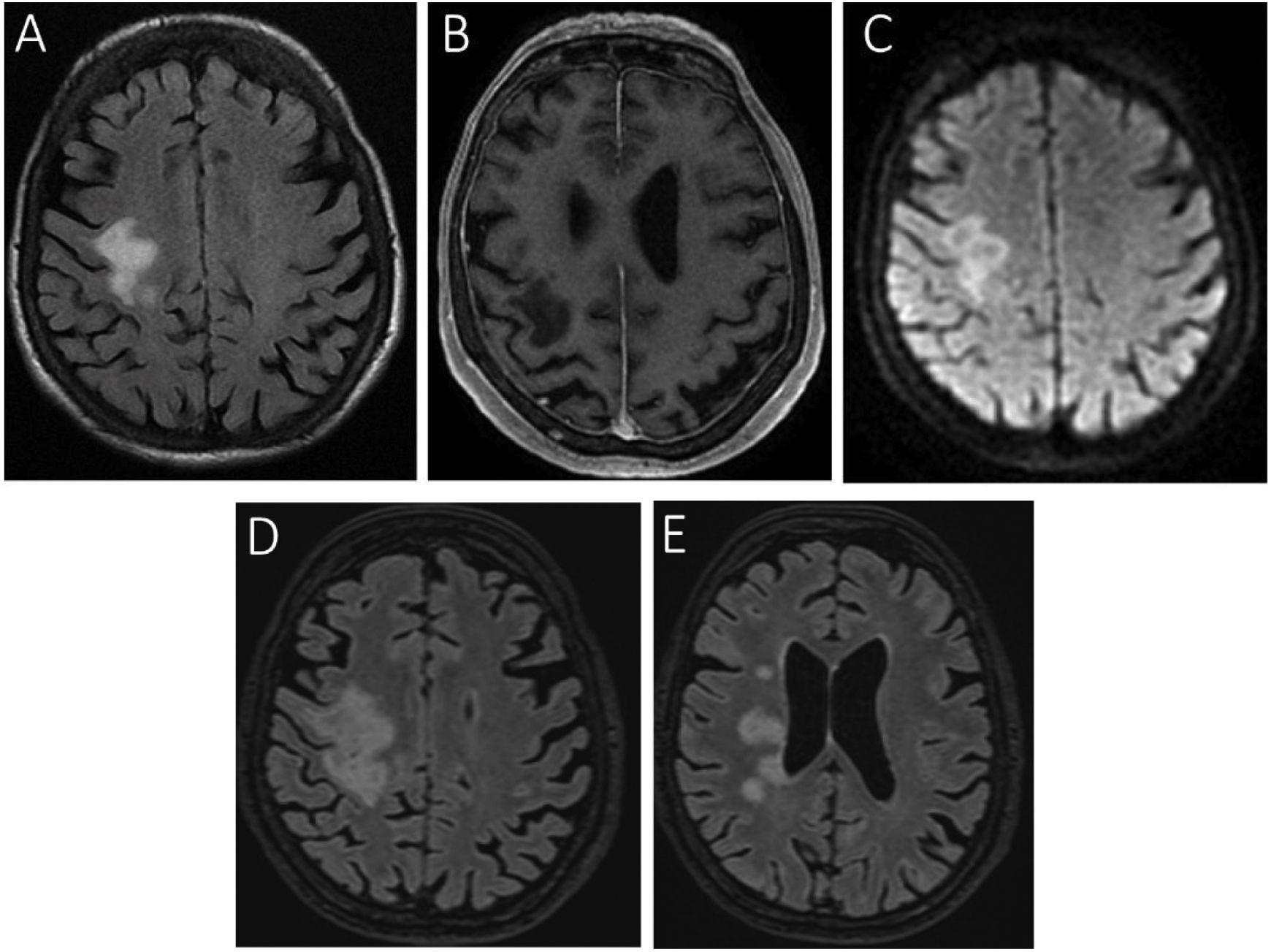 Progressive multifocal leukoencephalopathy: Report of a case preceding ...