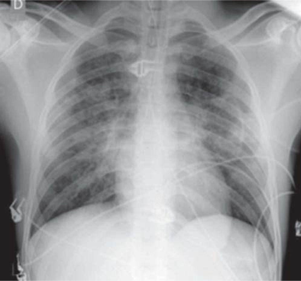 A rare form of acute pulmonary edema: Case report | Revista Portuguesa ...