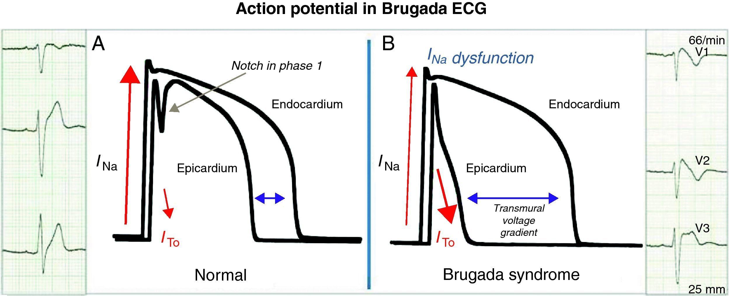 Diagnostic criteria for the Brugada syndrome: Can they be improved ...