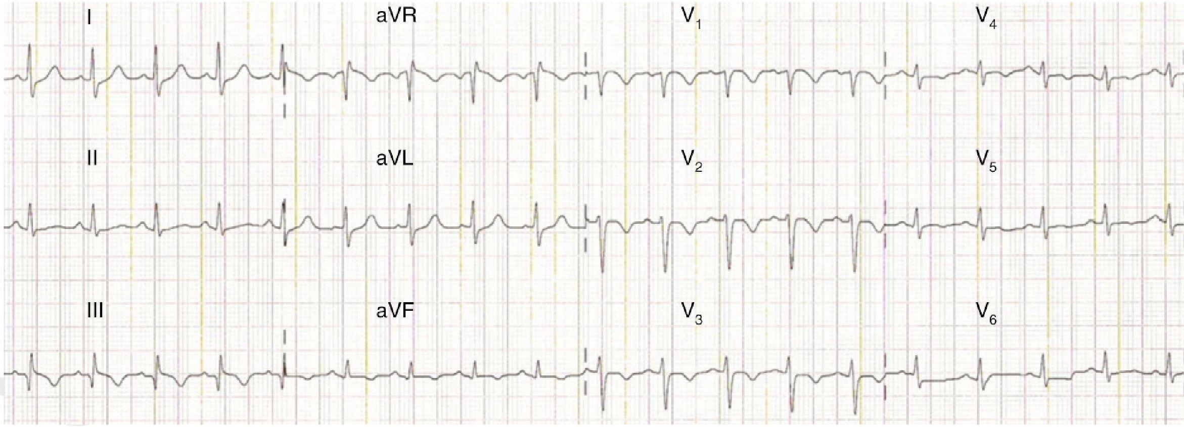 Pregnancy and acute pulmonary embolism: A case report | Revista ...