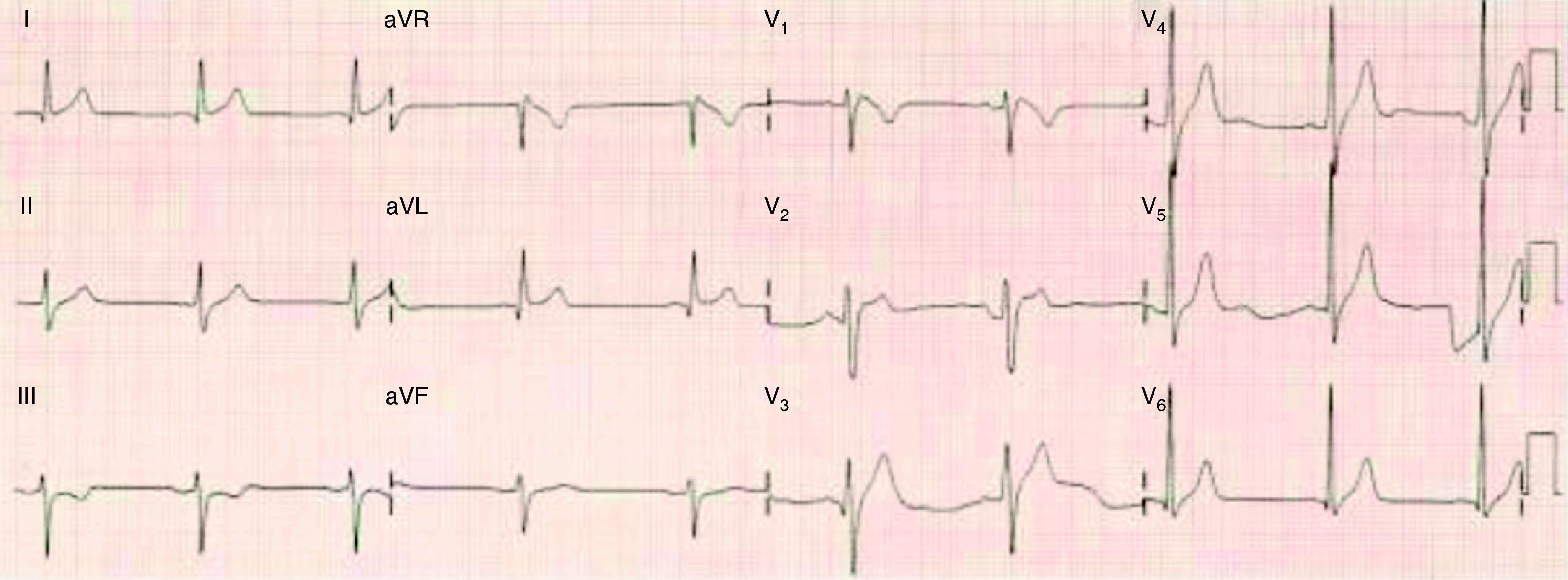 Syncope and intermittent Brugada ECG pattern | Revista Portuguesa de ...