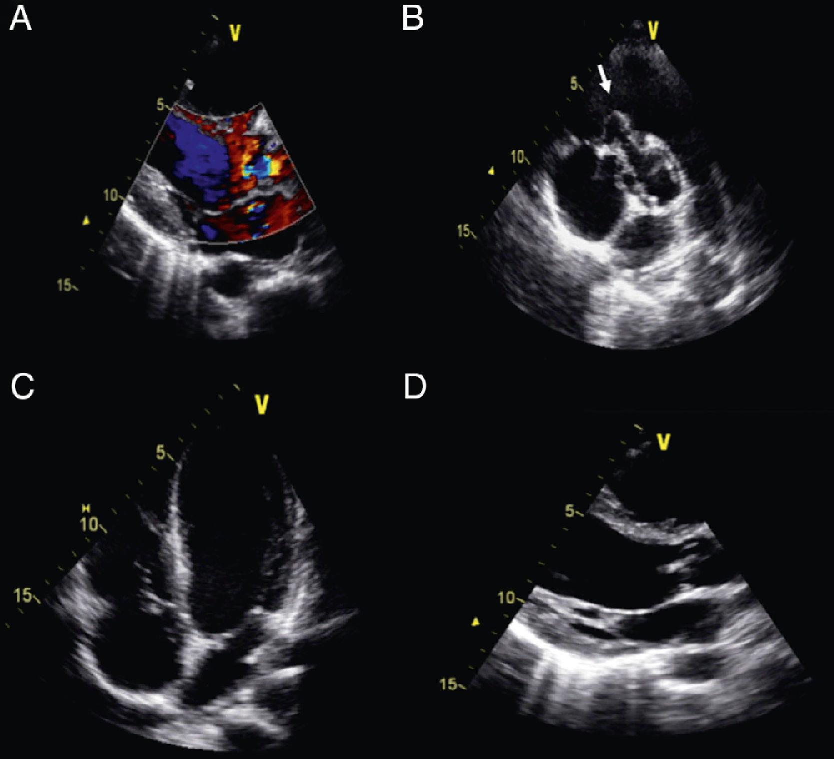 Perimembranous ventricular septal defect vegetation in a patient with ...