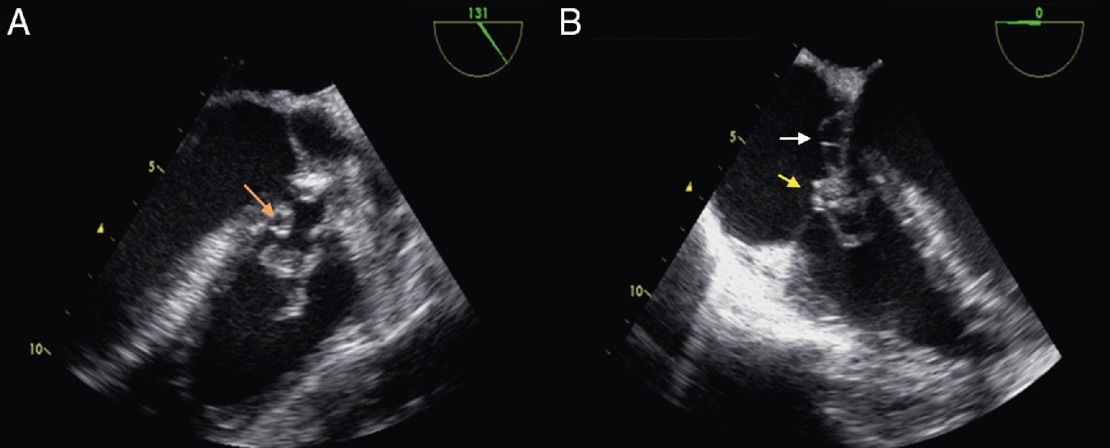 Perimembranous ventricular septal defect vegetation in a patient with ...
