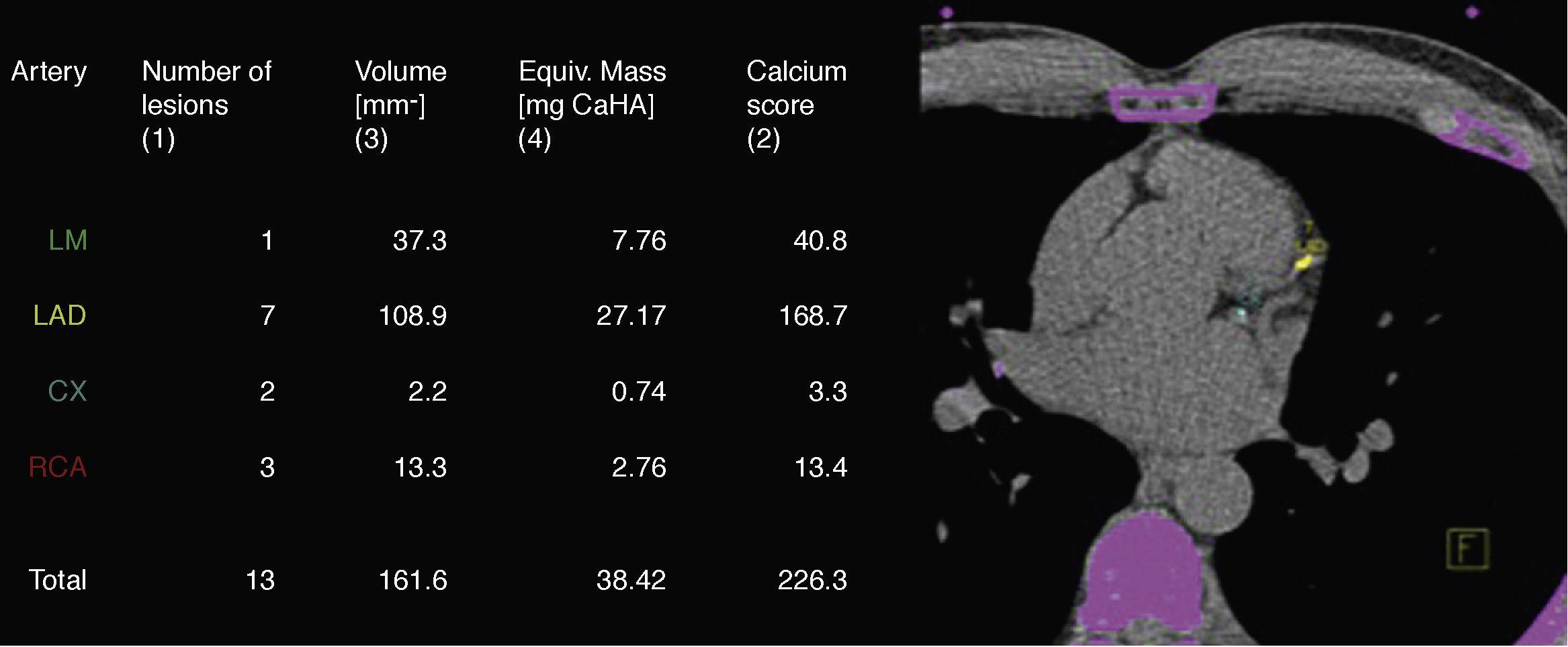Non-obstructive coronary artery disease documented by cardiac computed ...