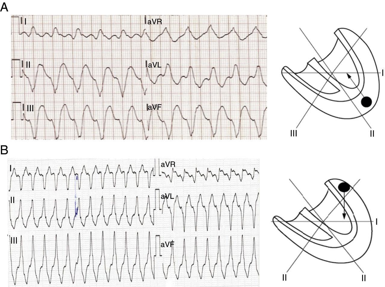 Wide Qrs Complex Tachycardia