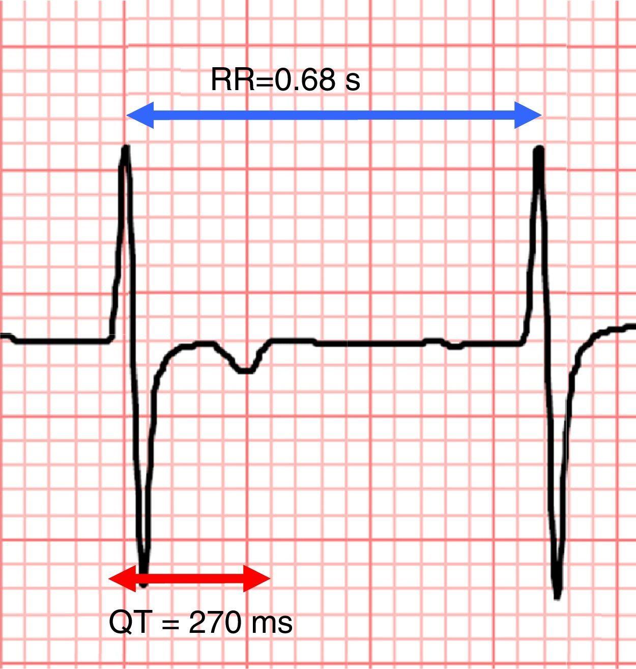 Short QT syndrome presenting as syncope: How short is too short ...