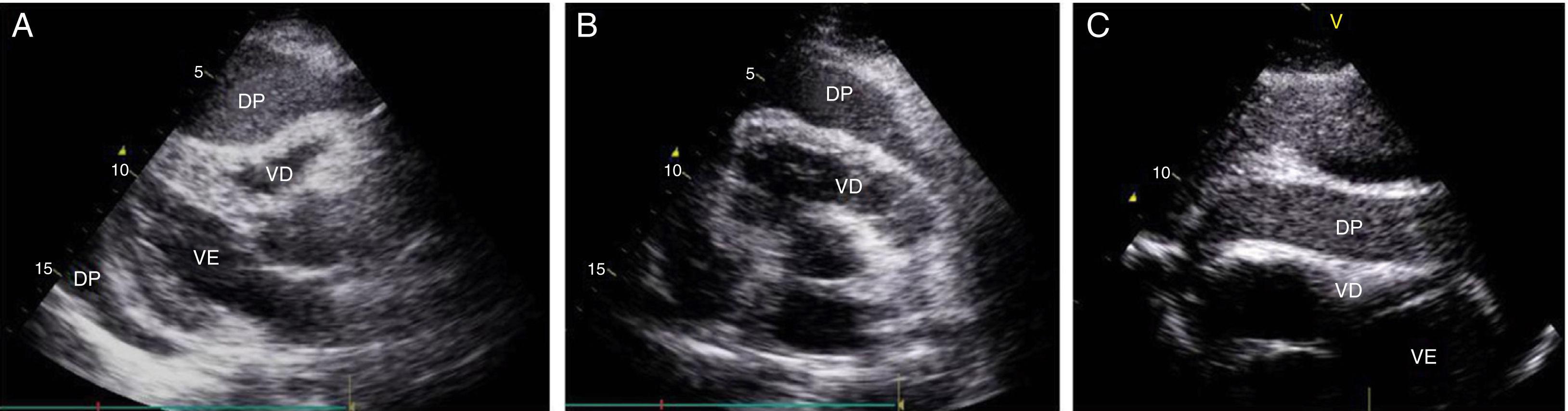 Pericarditis Echo