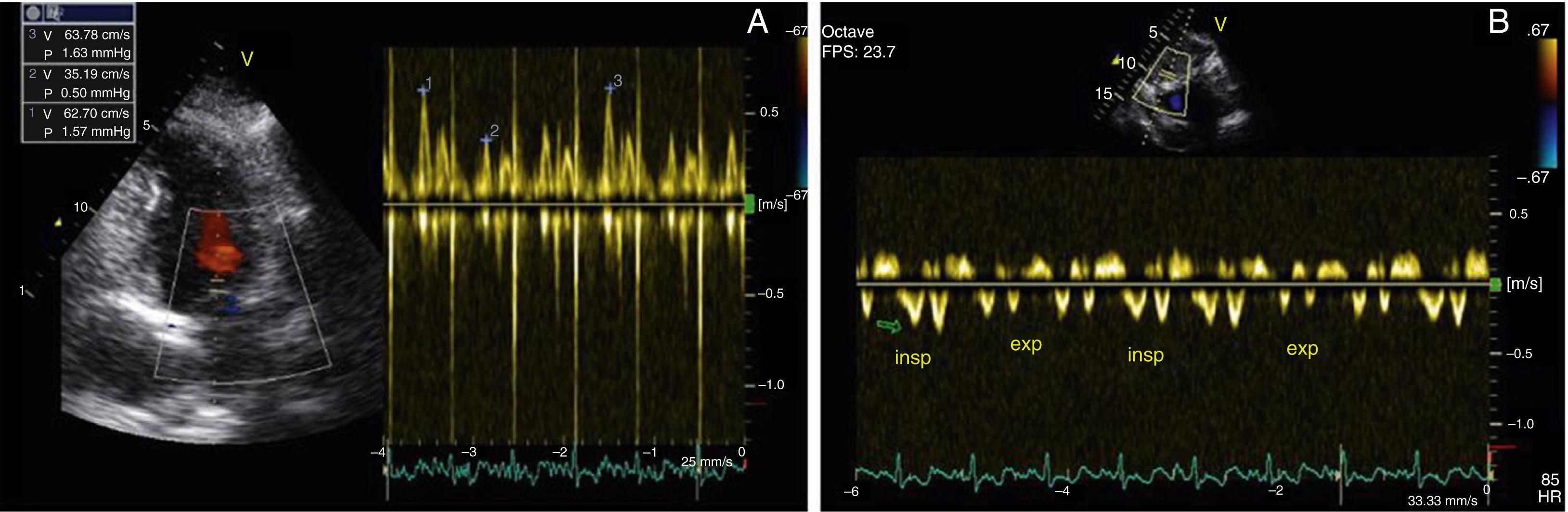 Effusive-constrictive pericarditis as the manifestation of an ...