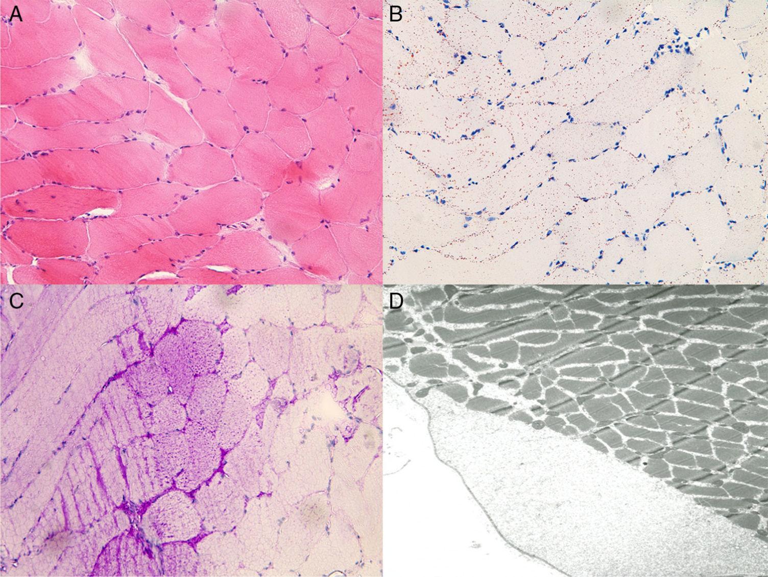 Syncope and hyperCKemia as minimal manifestations of short CTG repeat ...