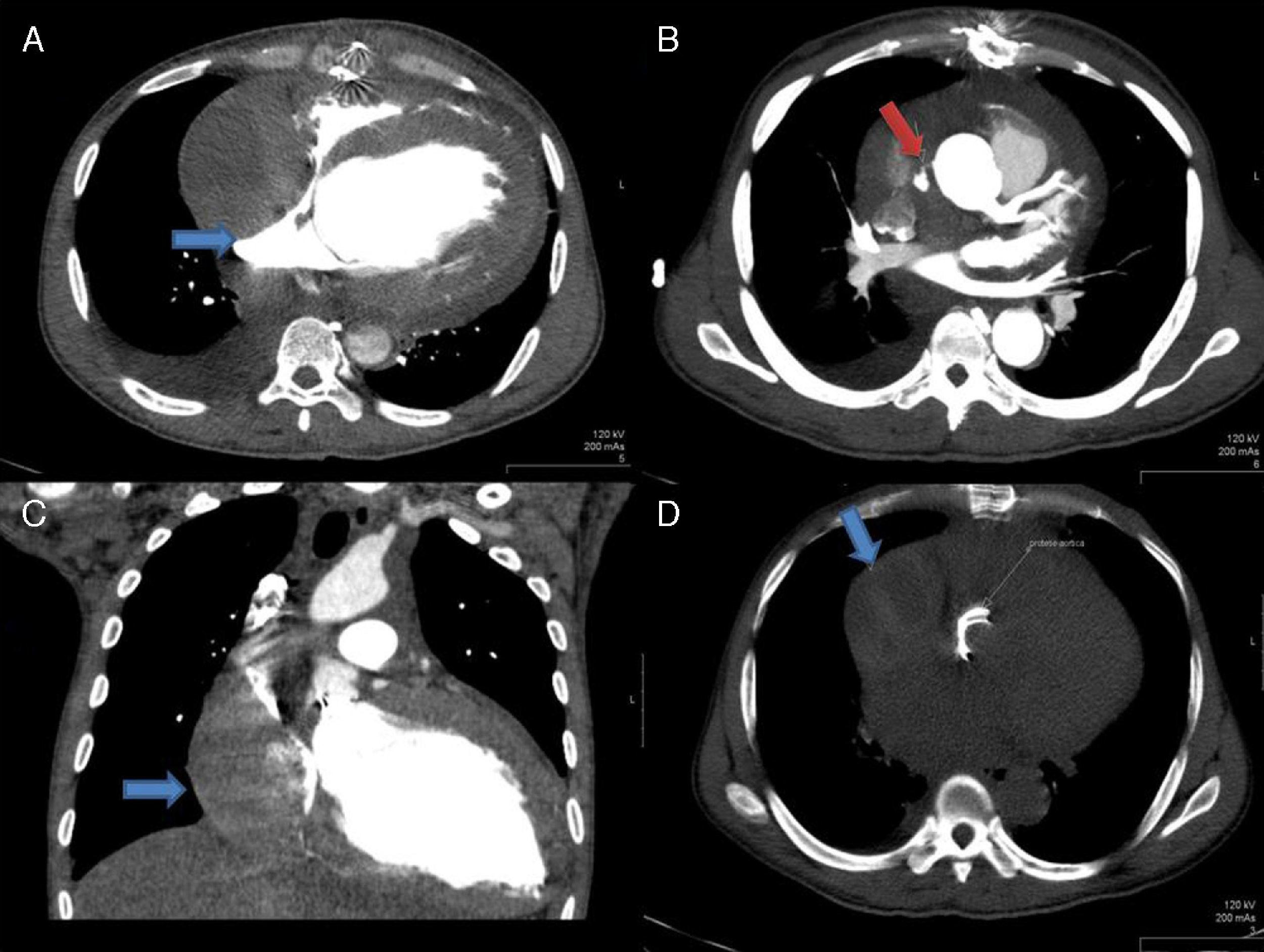 Loculated cardiac hematoma causing hemodynamic compromise after cardiac ...