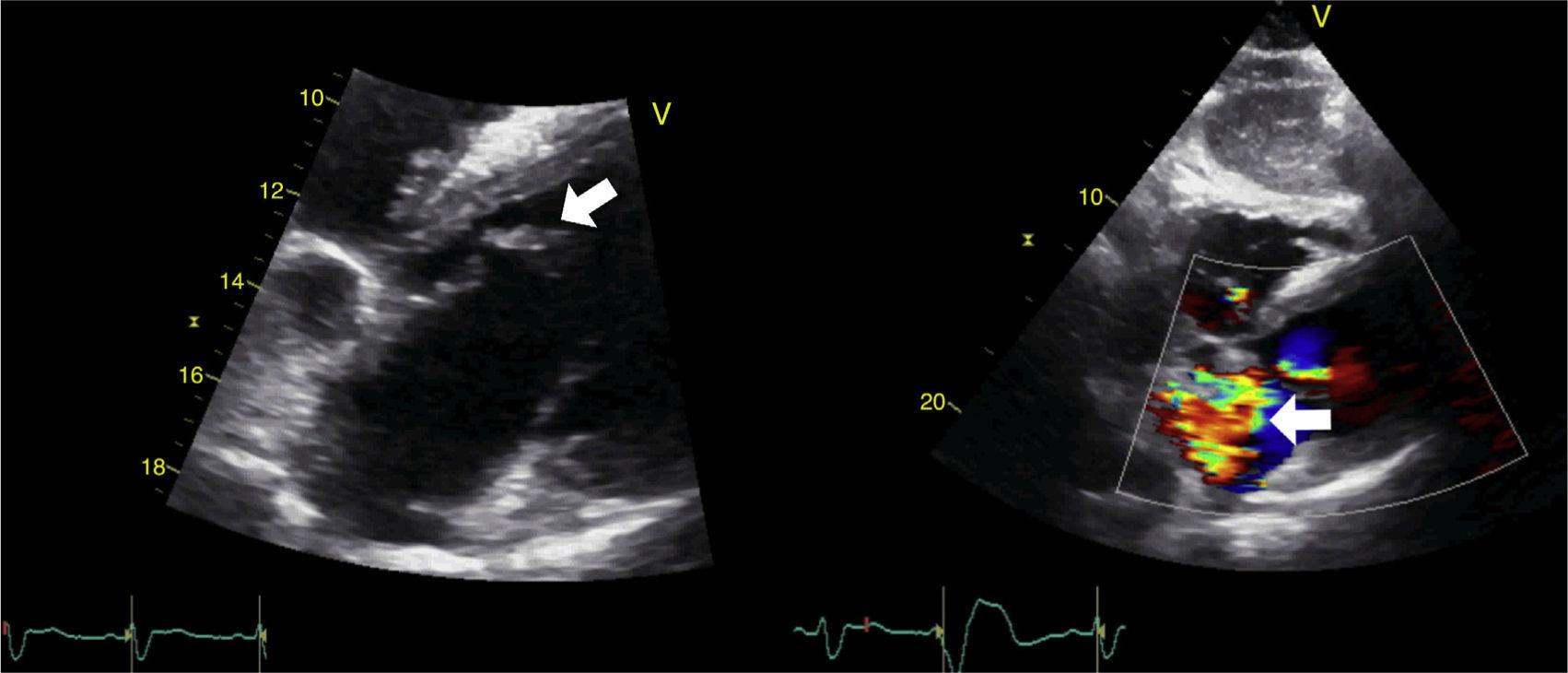 Anterolateral papillary muscle rupture after intervention of the right ...