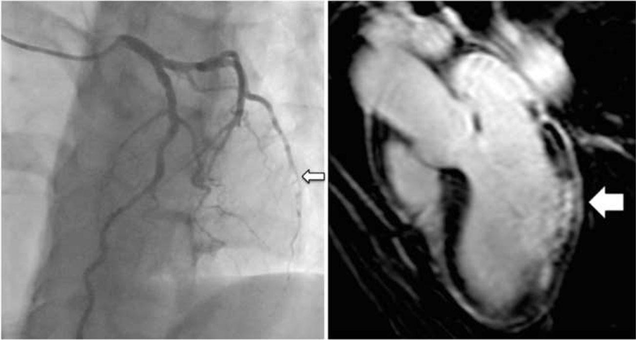 A rare case of concomitant stress (takotsubo) cardiomyopathy and acute ...