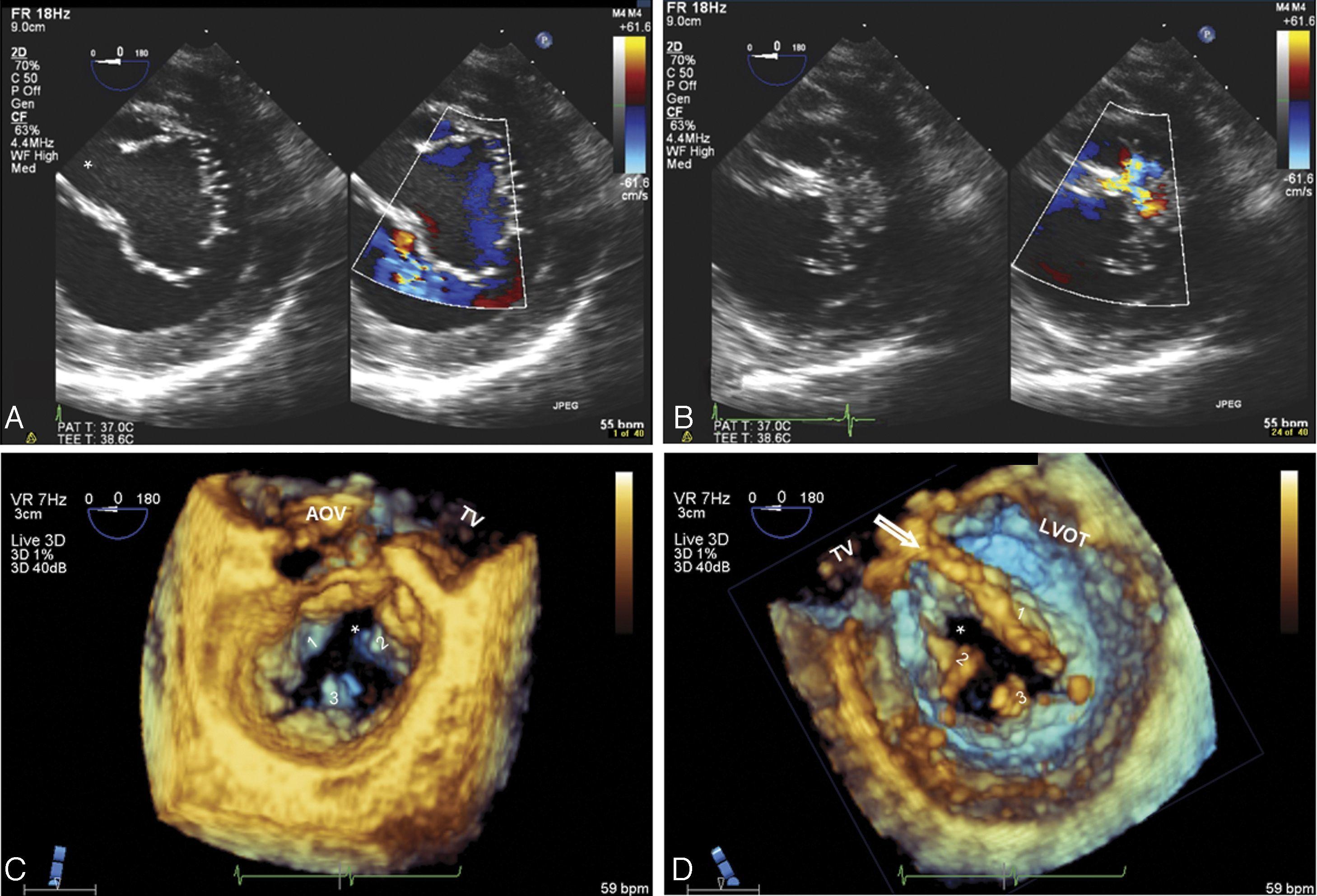 Atrioventricular septal defect in an adult patient: There are ‘clefts ...