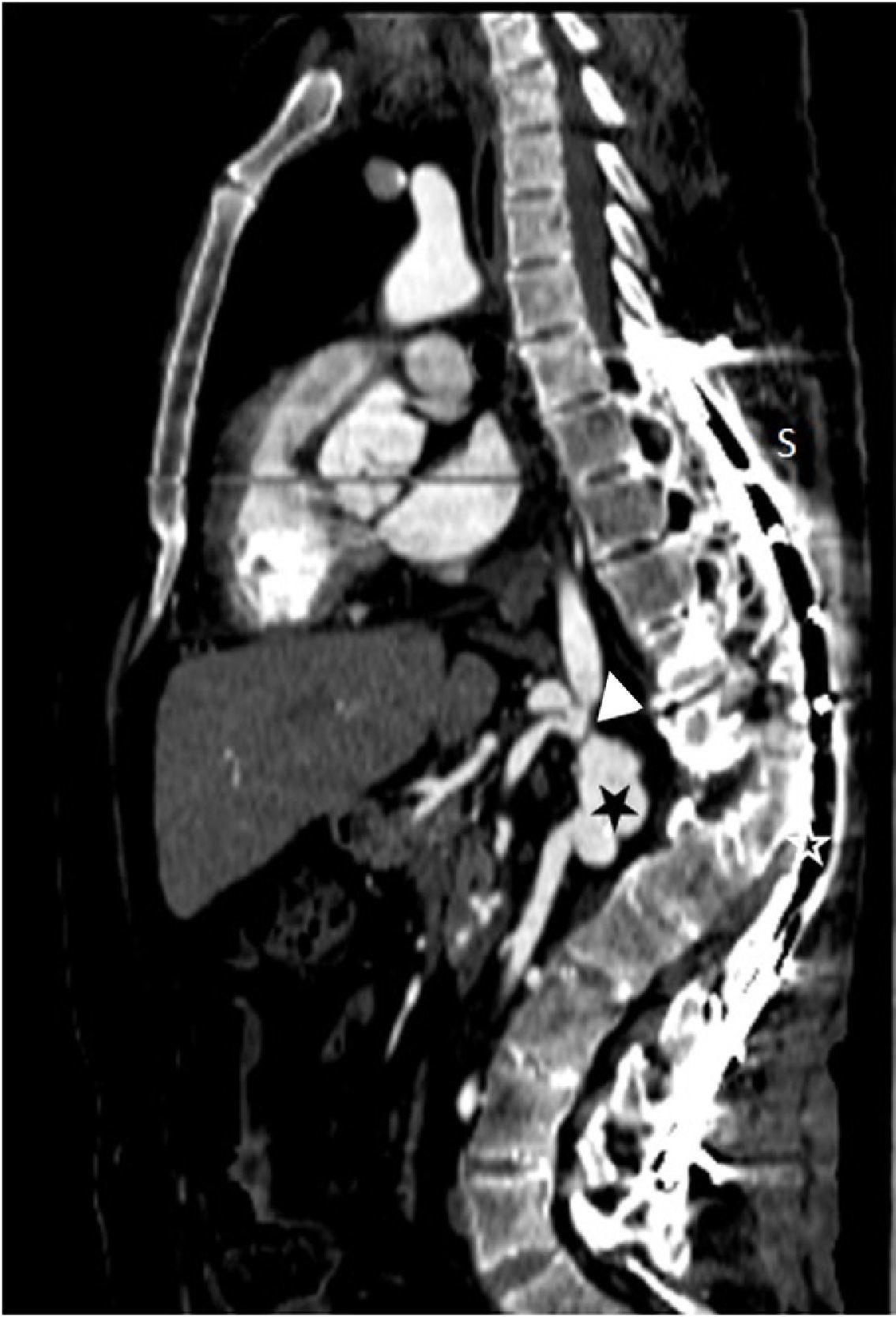 Mid-aortic syndrome in a patient with neurofibromatosis type 1 ...