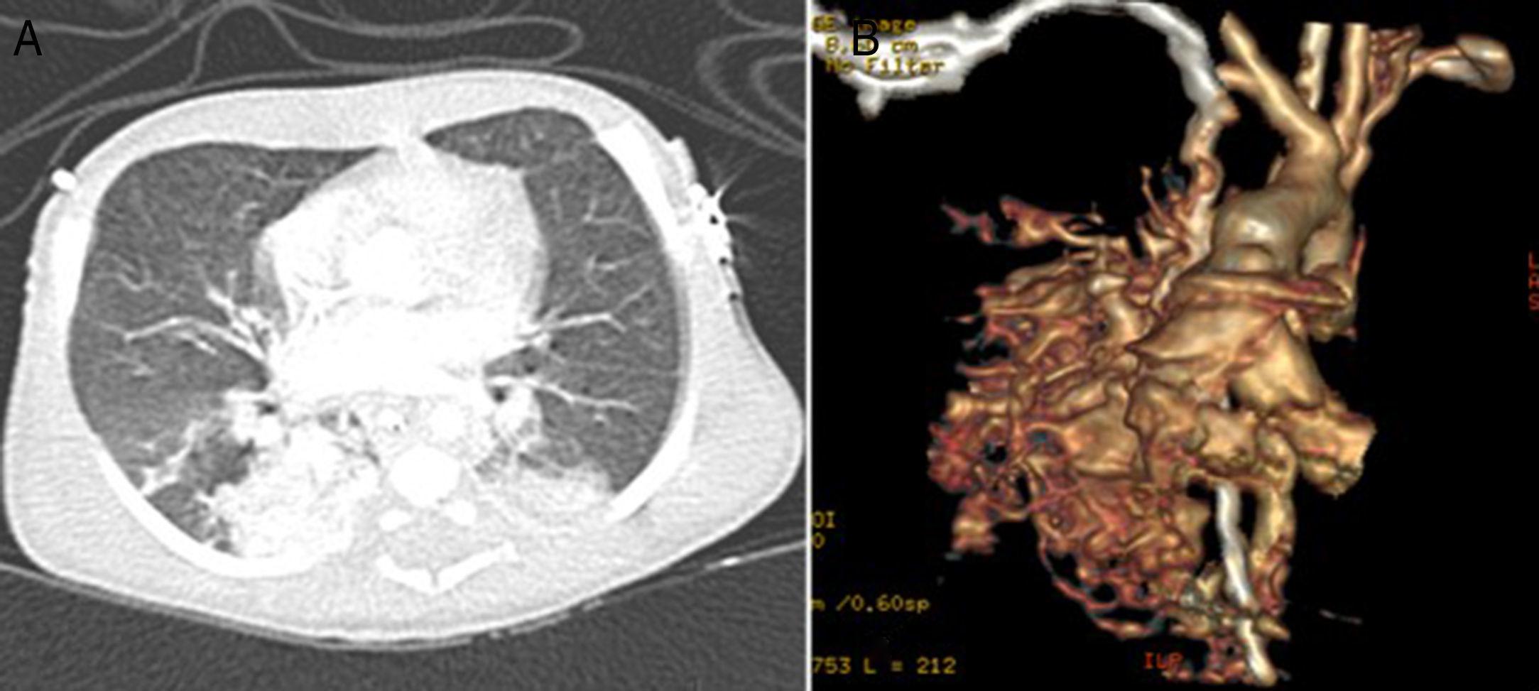 Pulmonary arteriovenous malformation closure in a preterm newborn ...