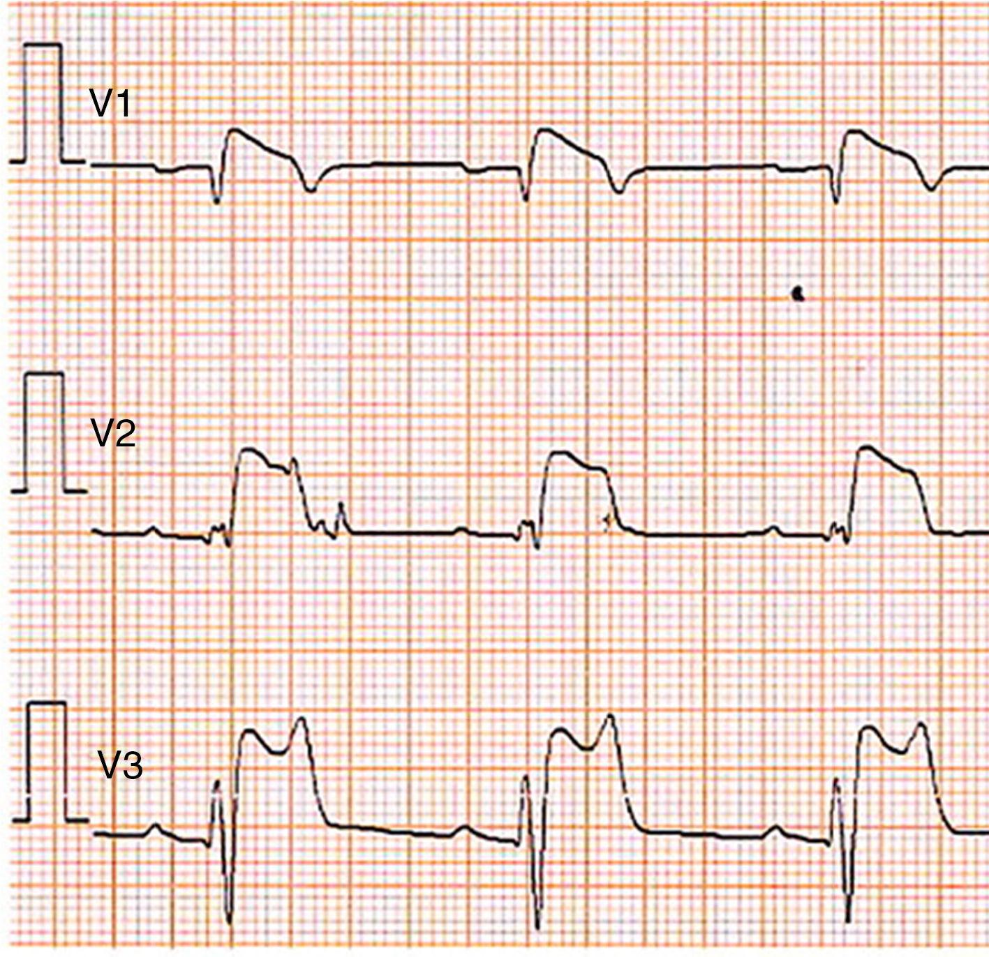 Induced Brugada syndrome: Possible sources of arrhythmogenesis ...