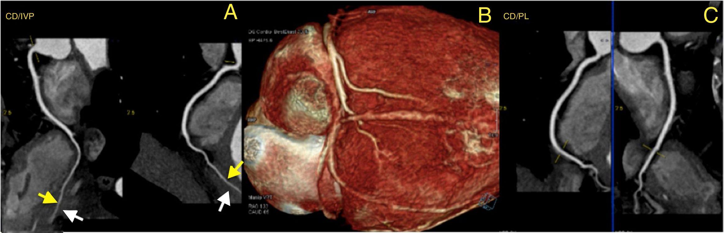 Three-vessel myocardial bridging: A possible cause of myocardial ...