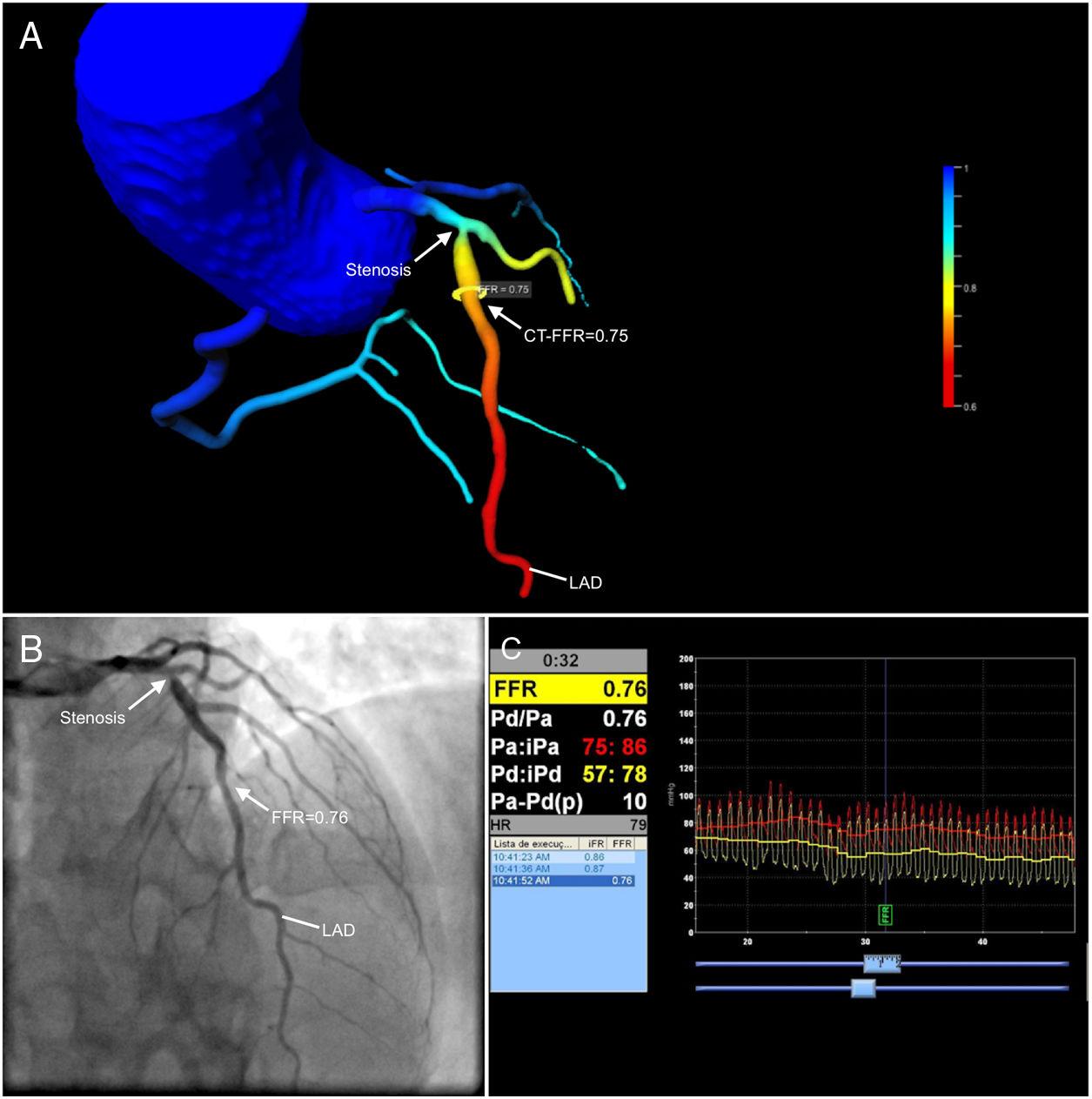 Functional assessment of coronary disease using workstation-based ...