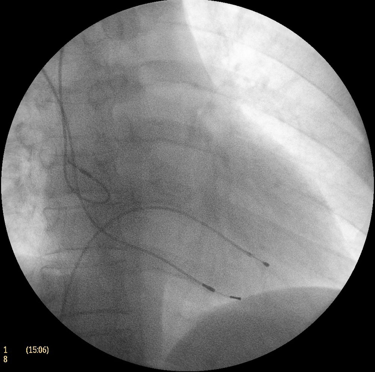 Left ventricular pacing with a temporary pacemaker: Case report ...