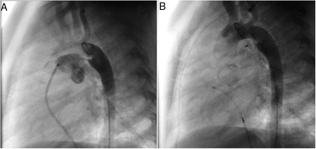 Patent Ductus Arteriosus X Ray
