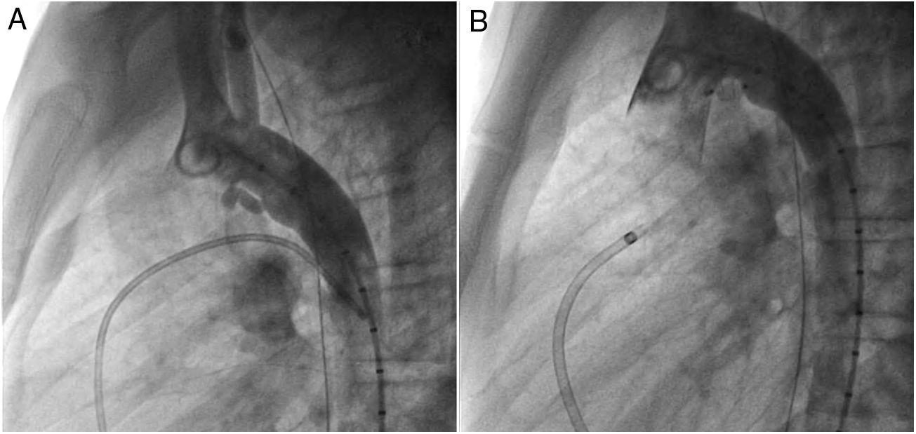Percutaneous patent ductus arteriosus closure: Twelve years of ...