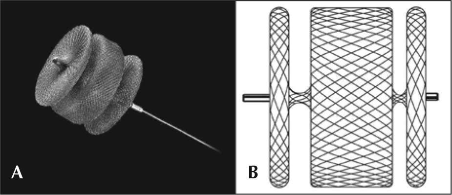 Percutaneous Occlusion of Patent Ductus Arteriosus with the Amplatzer ...