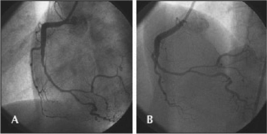 Intracoronary Haematoma as a Manifestation of Spontaneous Coronary ...