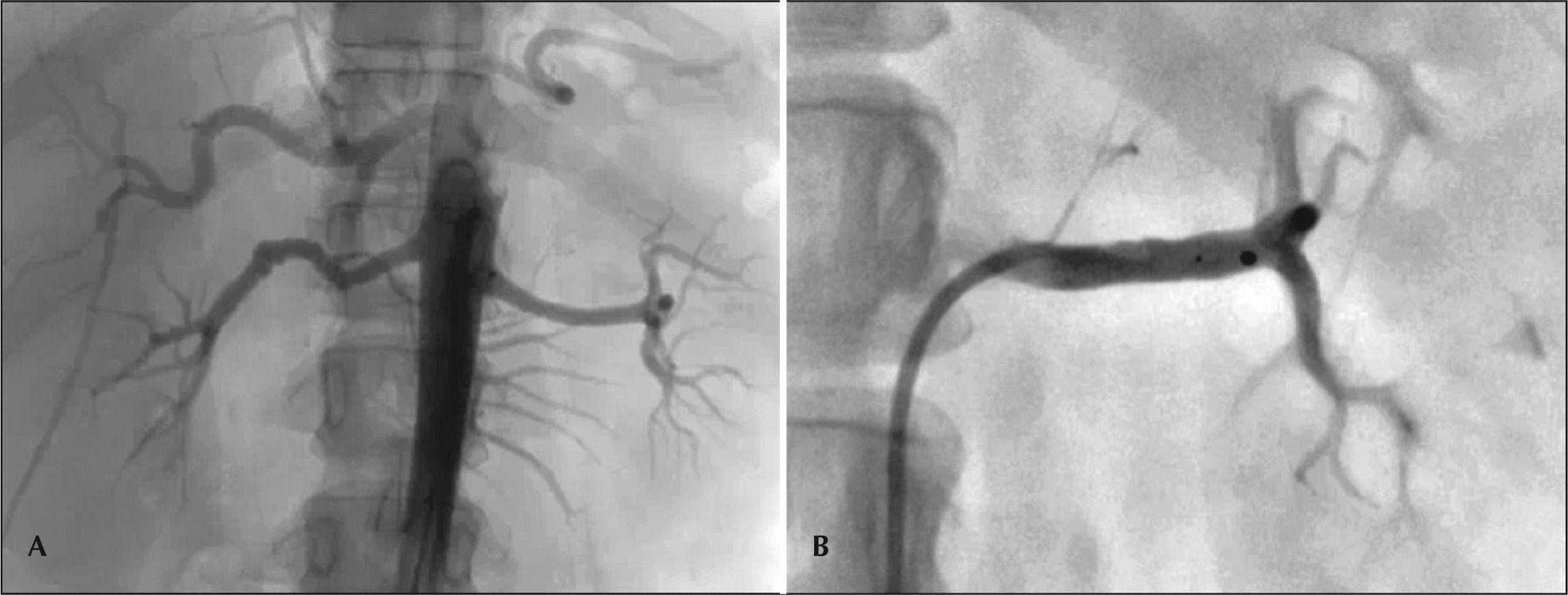 Renal Sympathetic Denervation for Treatment of Resistant Hypertension ...