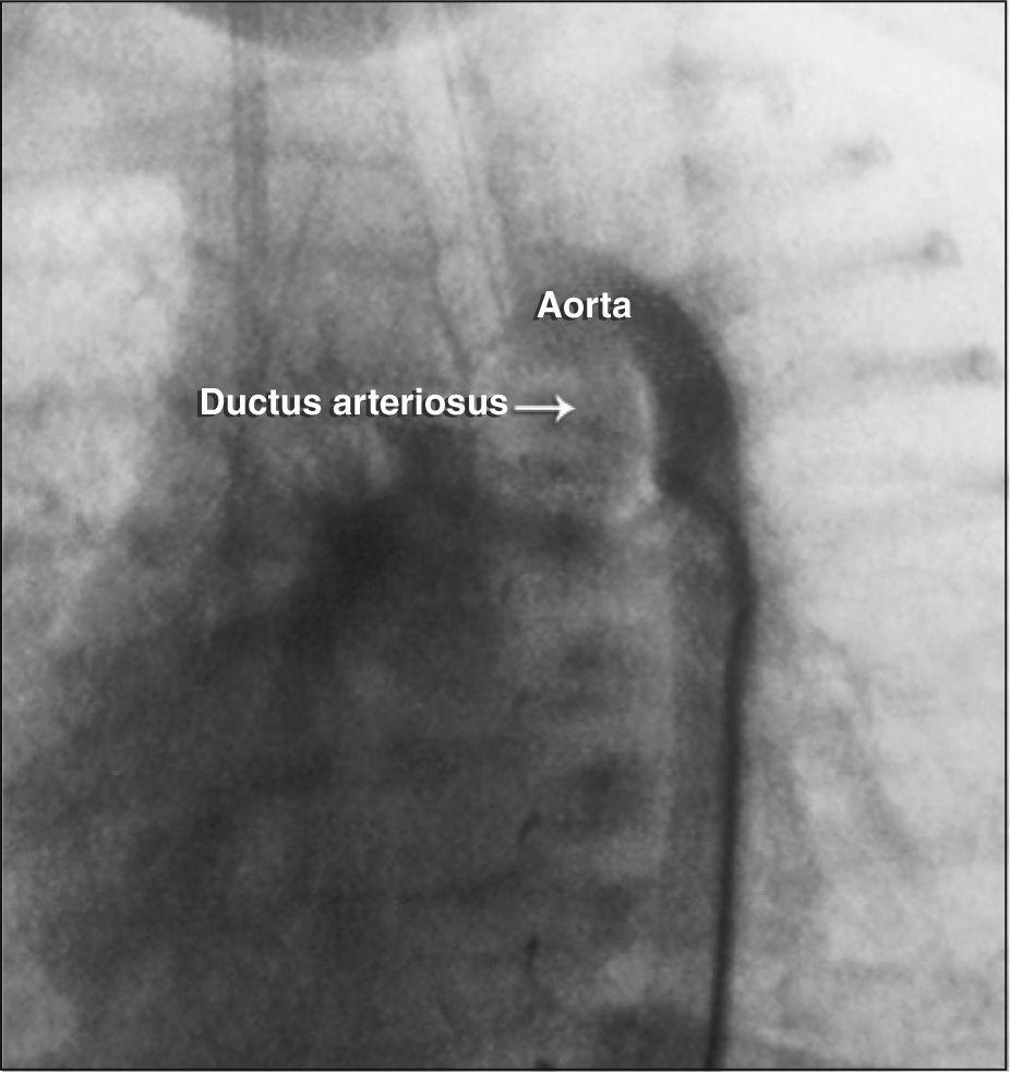 Stent Angulation and Implantation in the Ductus Arteriosus of a Low ...