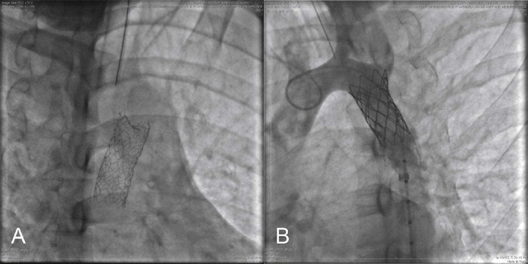 Use of covered stents in the treatment of aortic coarctation | Revista ...