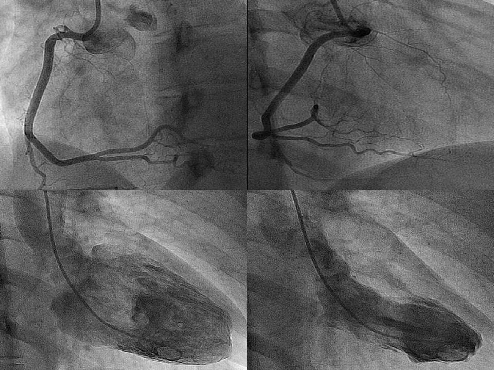Extensive spontaneous coronary dissection with favorable evolution ...