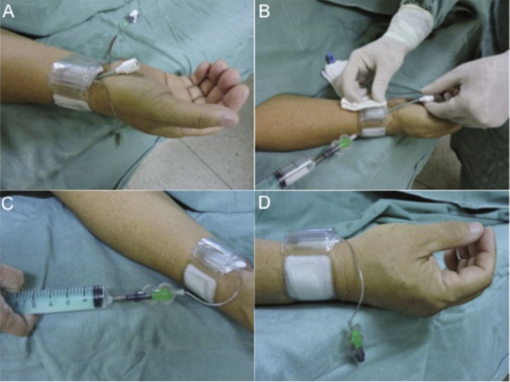 Comparison of conventional compressive dressings vs. wristband devices ...