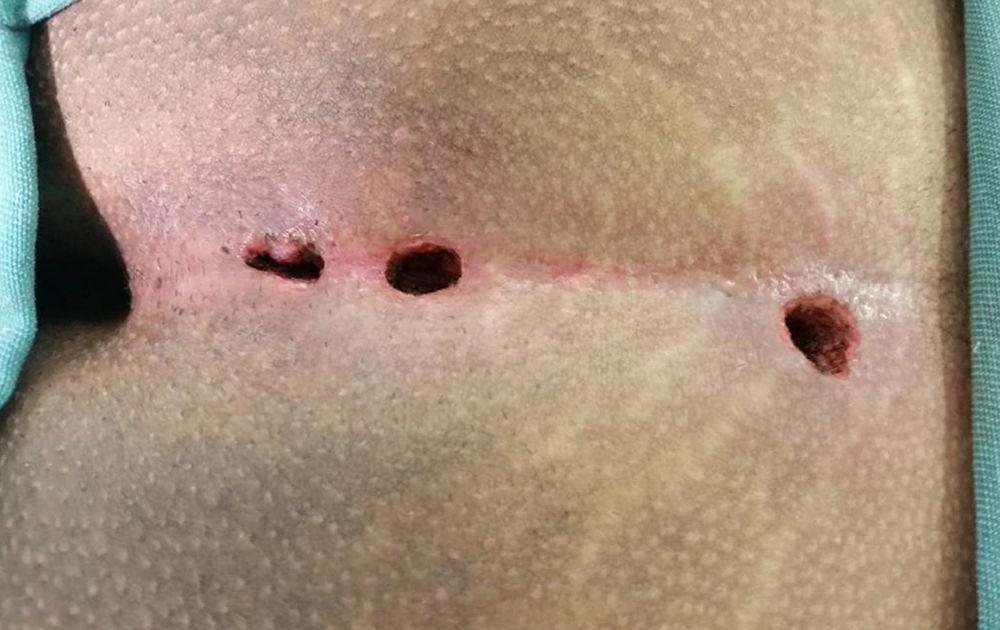 Healed Pilonidal Cyst Scar