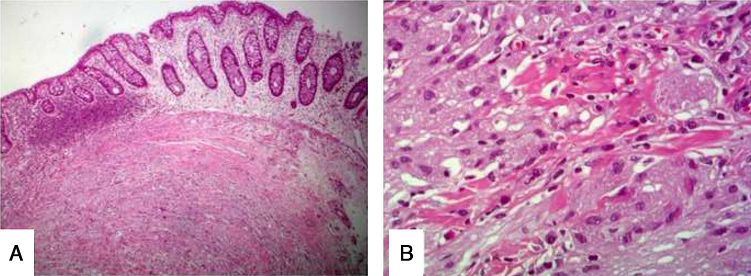 Granular Cell Tumor Colon