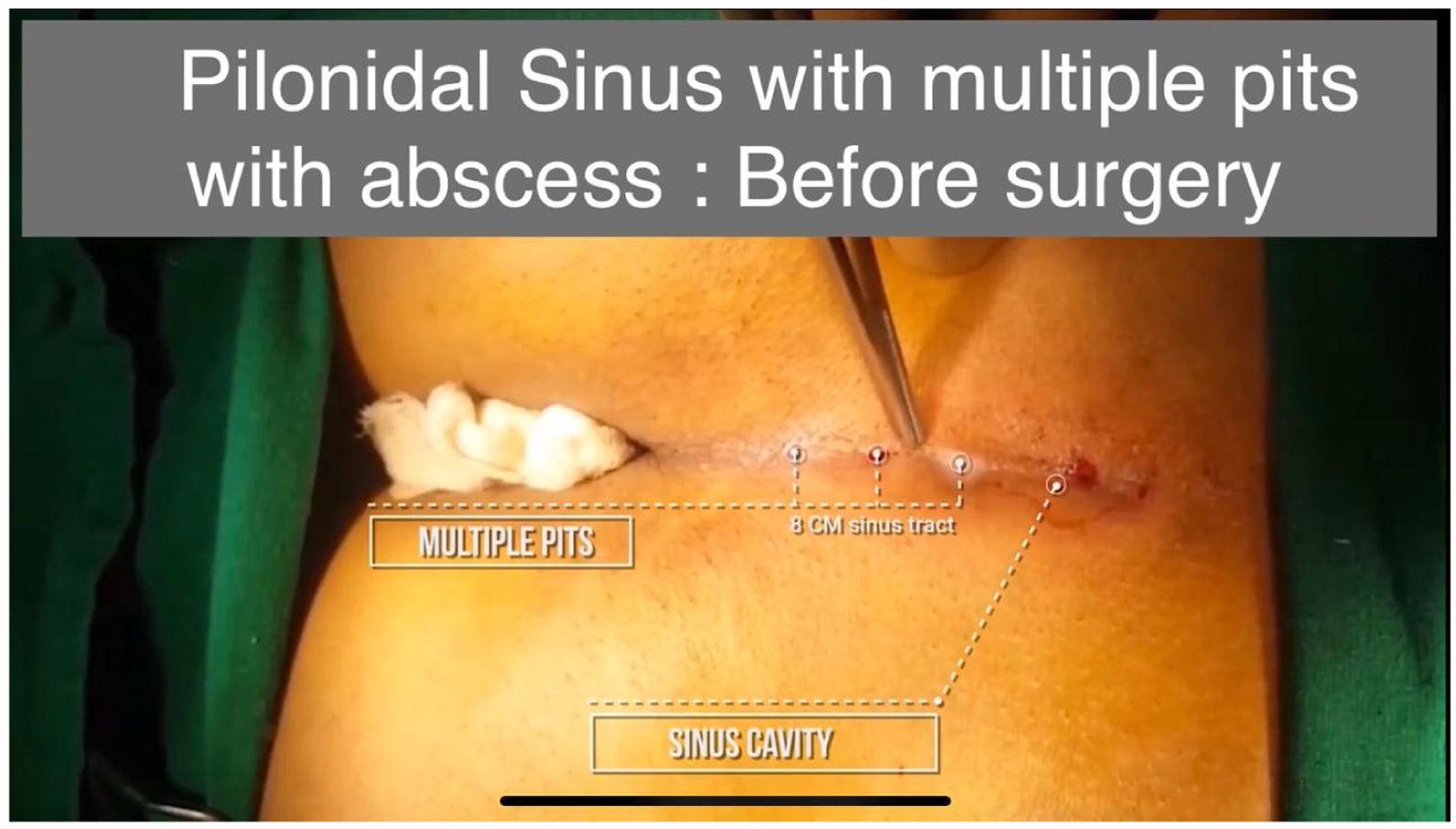 Infected Pilonidal Abscess