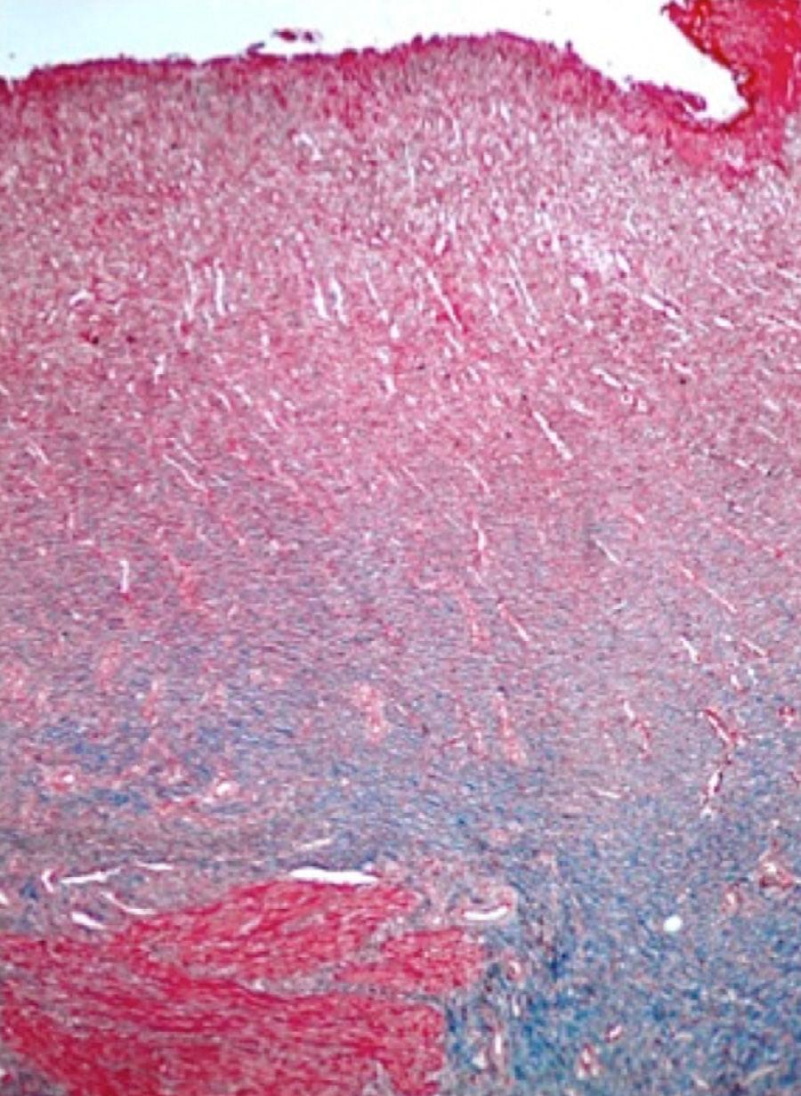 Peroral endoscopic full and partial-thickness myotomy. A viability ...