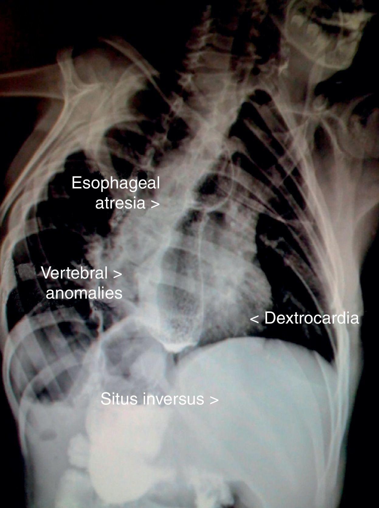 Esophageal Atresia X Ray