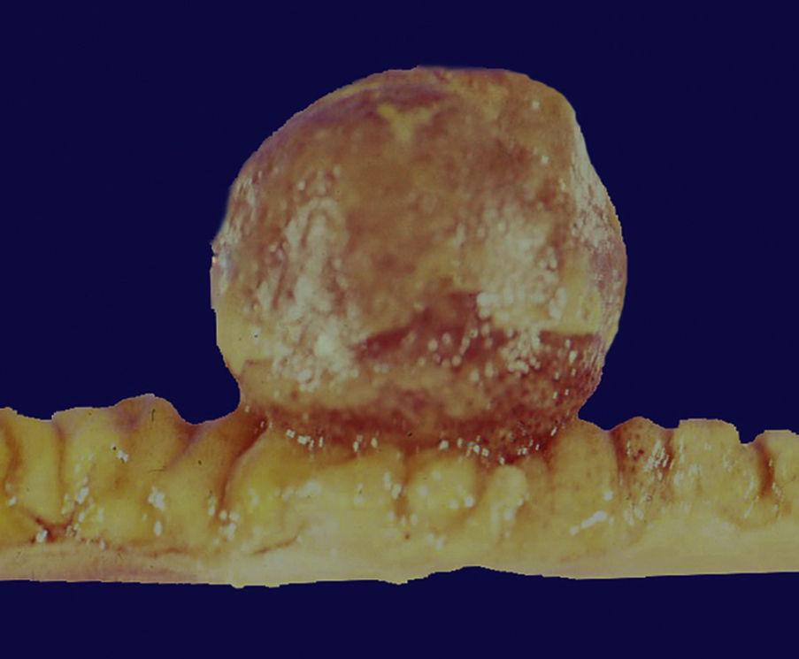 Inflammatory fibroid polyp of the gastrointestinal tract: 10 years of ...