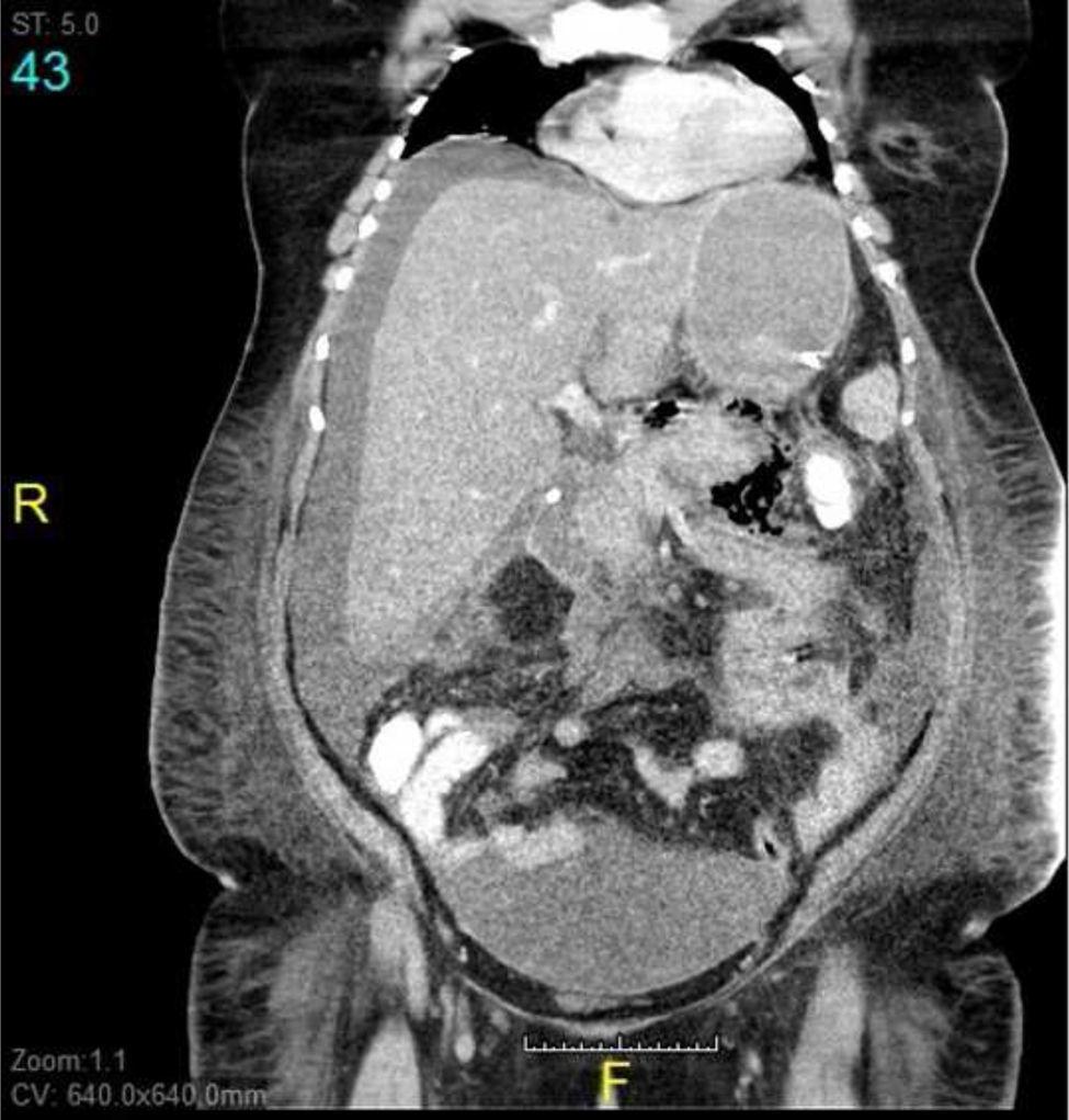 Colon necrosis secondary to acute pancreatitis: A case report and ...