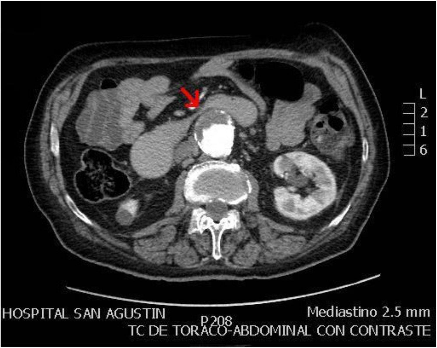 Duodenal stricture secondary to Richter’s syndrome | Revista de ...
