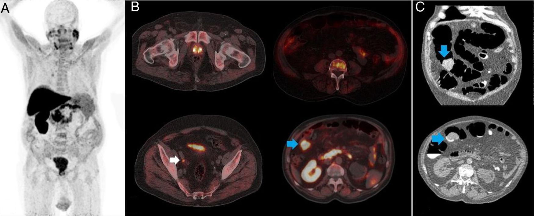 Metachronous colon tumor detected utilizing 18F-choline PET/CT in a ...