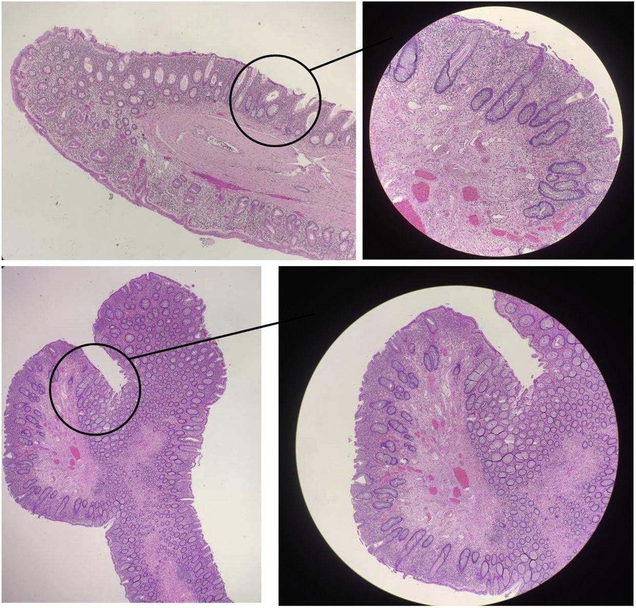 Filiform polyposis. A rare complication in a patient with inflammatory ...
