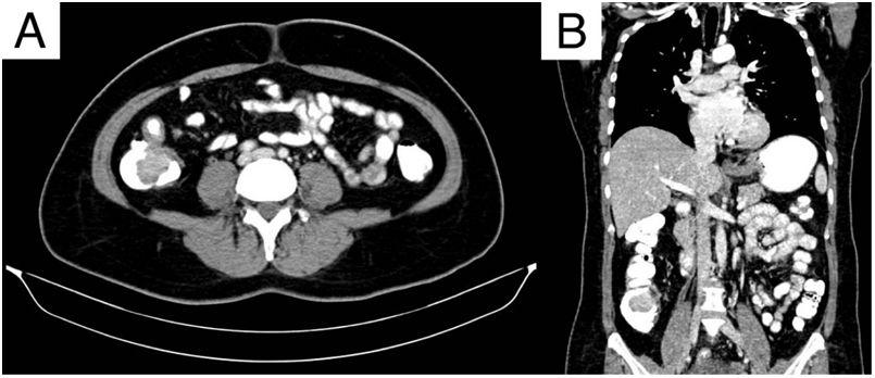 Neuroendocrine tumor of the ileocecal valve: A case report and review ...