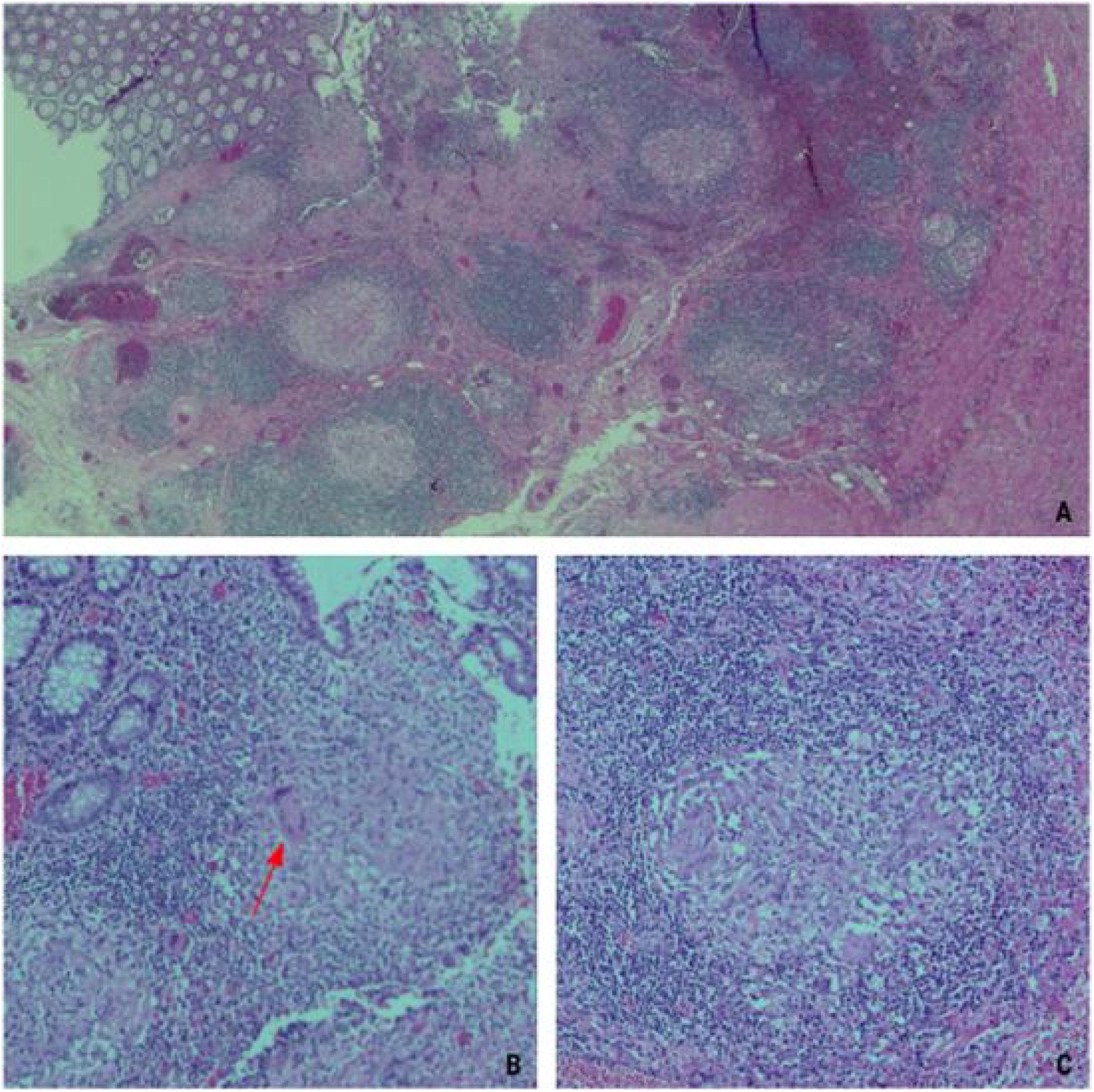 Intestinal tuberculosis mimicking colon cancer | Revista de ...