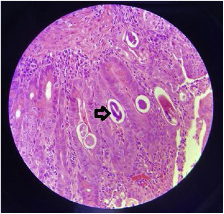 Severe gastroduodenitis due to Strongyloides stercoralis infection: An ...