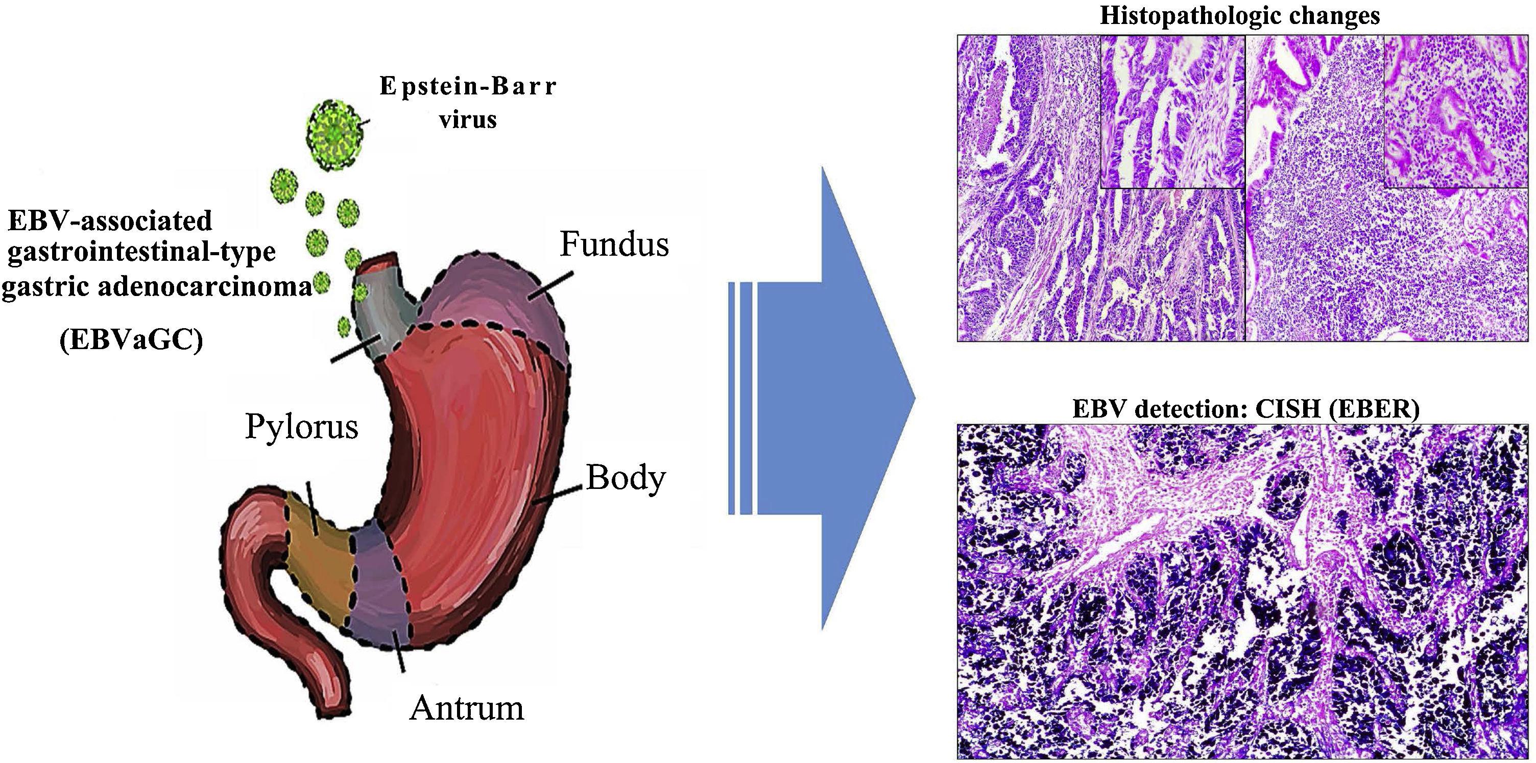 Clinical and pathologic characteristics of gastric adenocarcinoma ...