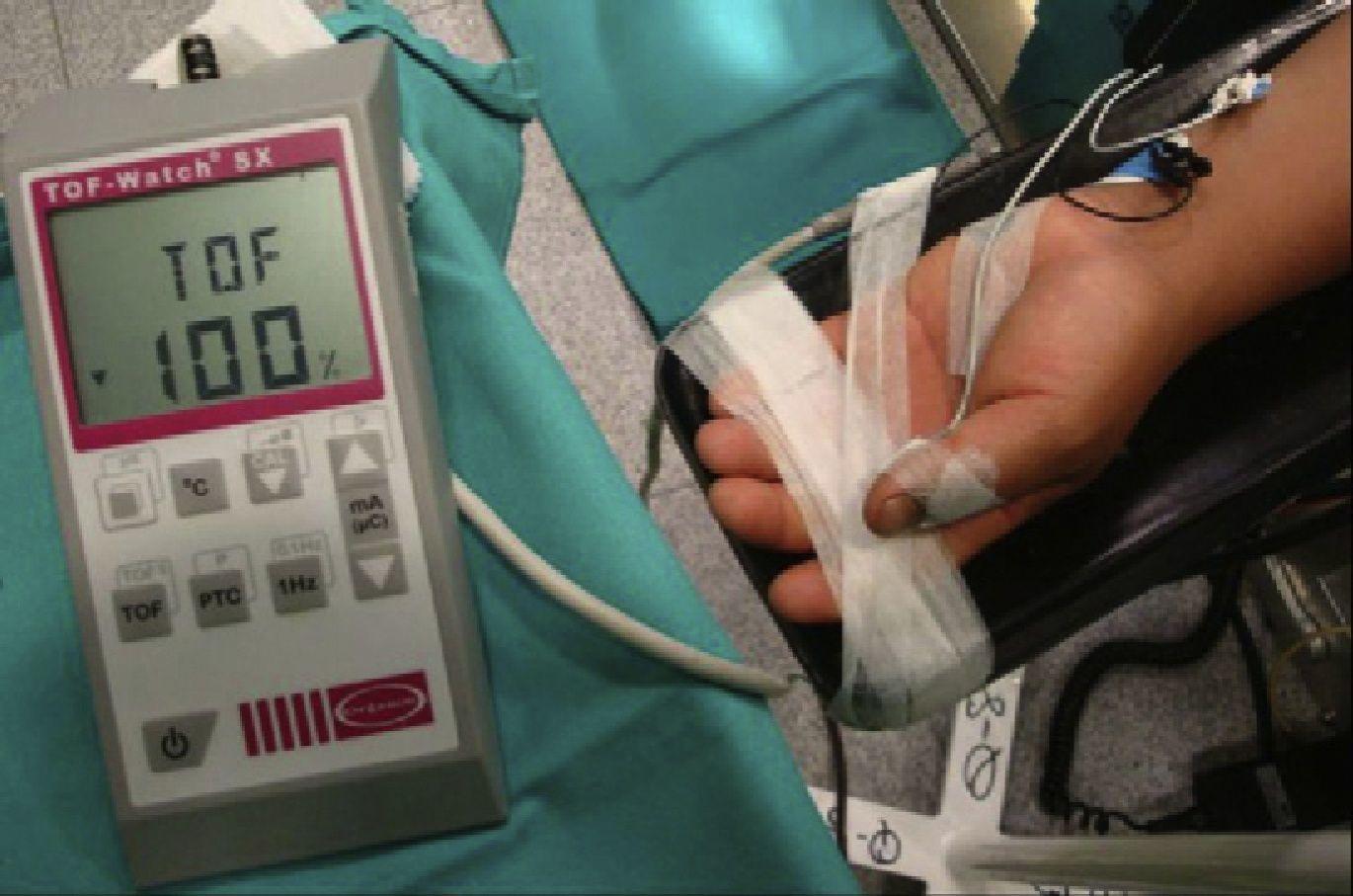 Neuromuscular monitoring and its importance in neuromuscular blockade ...