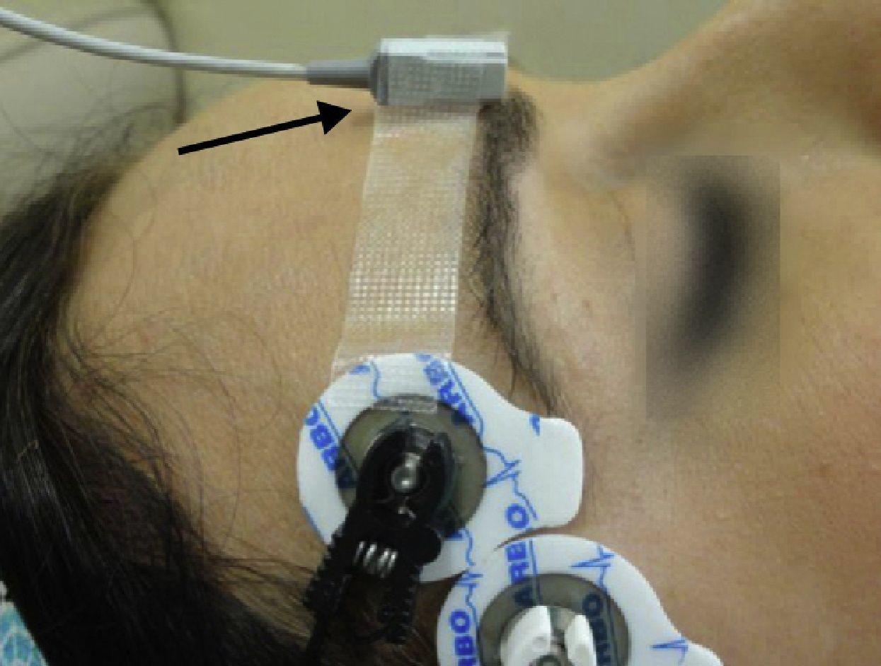 Neuromuscular monitoring and its importance in neuromuscular blockade ...