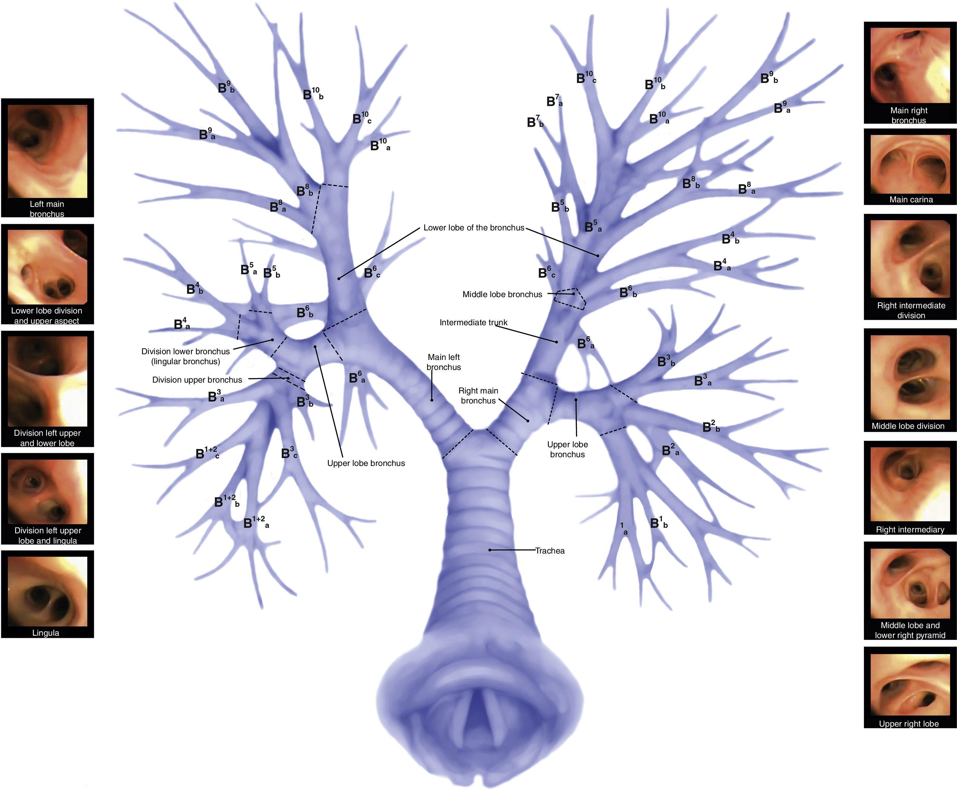 Airway anatomy for the bronchoscopist: An anesthesia approach ...