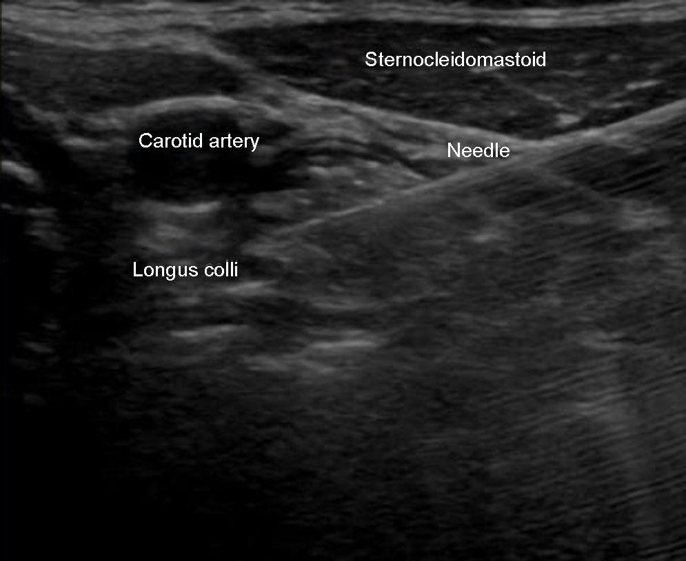 Longus Colli Ultrasound
